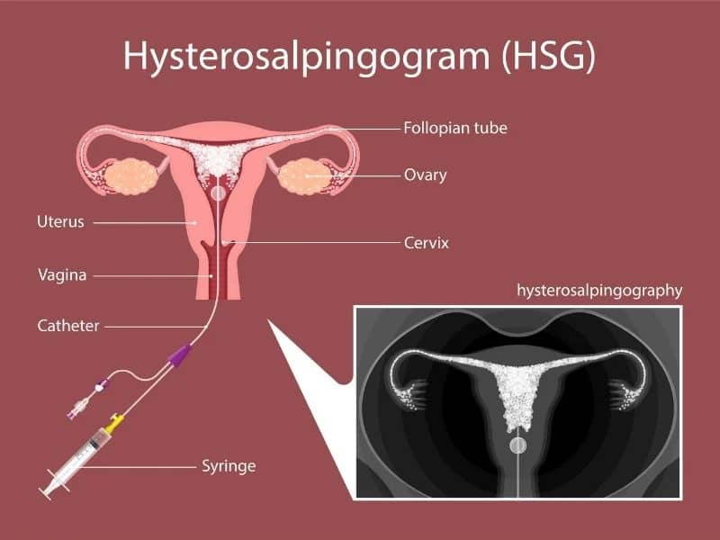 HSG 